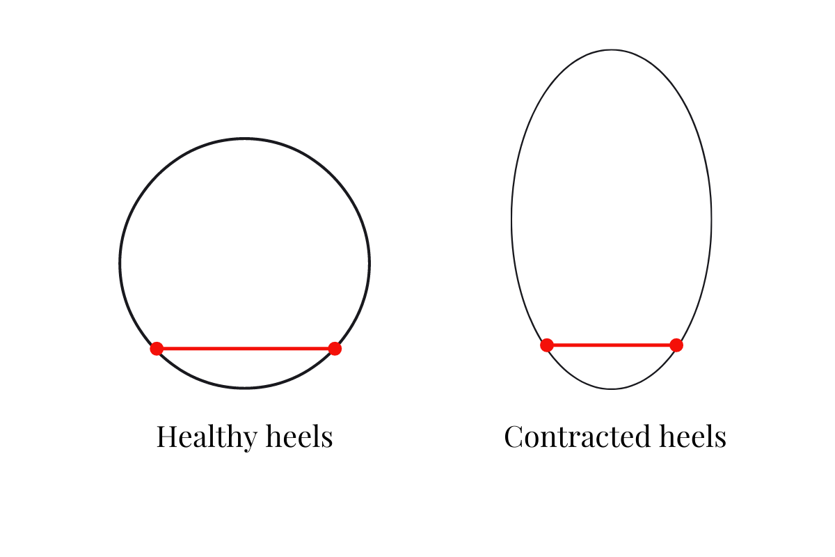 What are contracted heels? – HQ Magazine